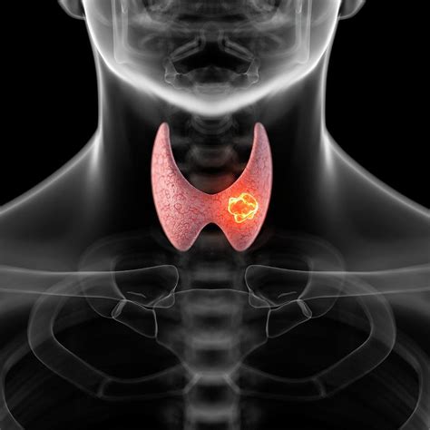 Tumor In Human Thyroid Photograph By Sciepro Fine Art America