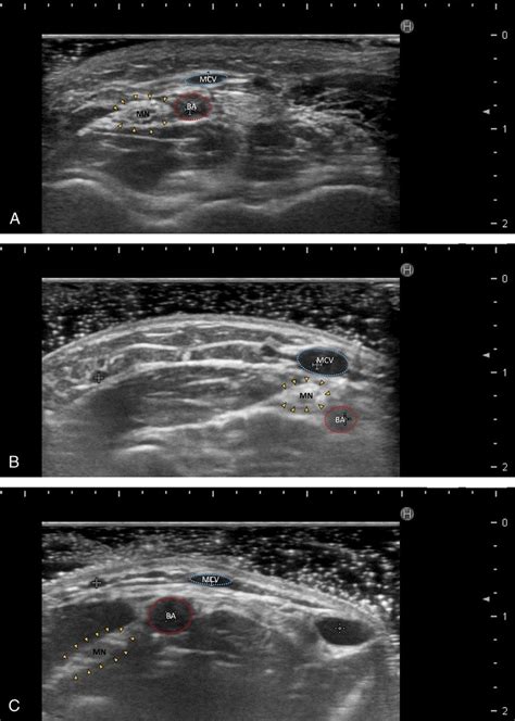 ultrasound images showing positional relationships between the median