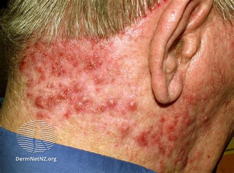 Folliculitis The London Skin And Hair Clinic