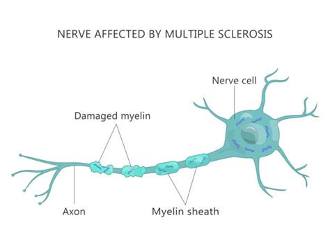 Multiple Sclerosis Neuron