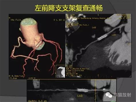 冠脉支架及搭桥术后评估、cta与dsa技术比较