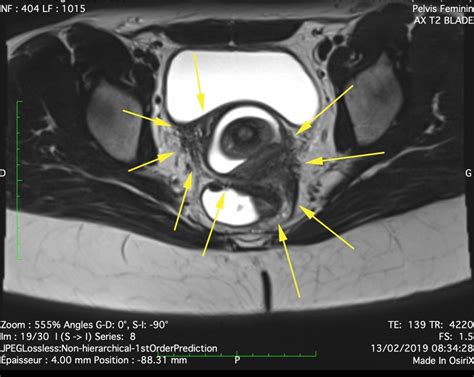Disc Excision Still Feasible In Huge Deep Endometriosis Of The Low Rectum With Hydronephrosis