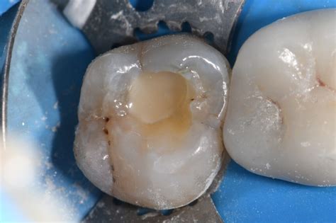Deep Amalgam Restorations Ever X Flow