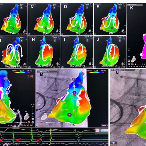 Abbreviations Mat Macro Reentrant Atrial Tachycardia At Atrial