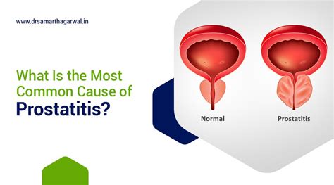 What Is The Most Common Cause Of Prostatitis Dr Samarth Agarwal
