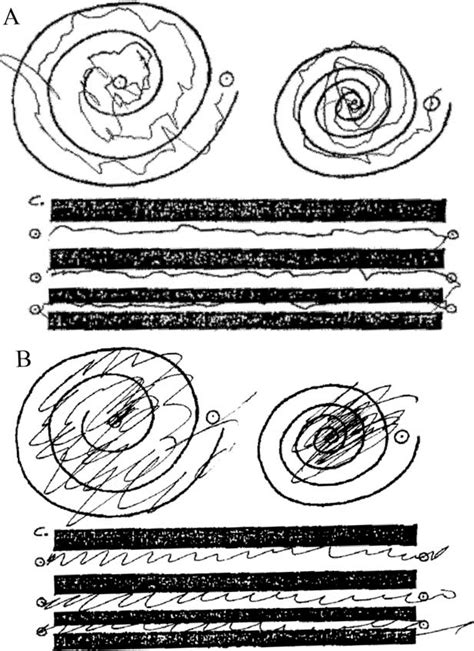 Spirals From The Clinical Rating Scale For Tremor A Case 1 B Case 2 Download Scientific