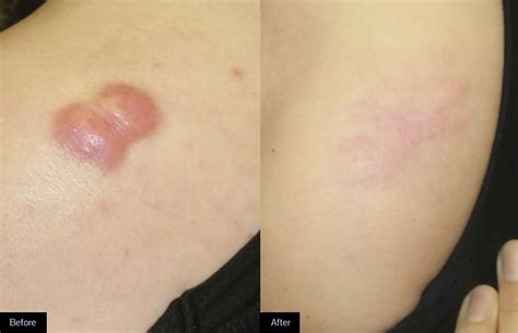 Keloid Treatments — Ingleton Dermatology Pc