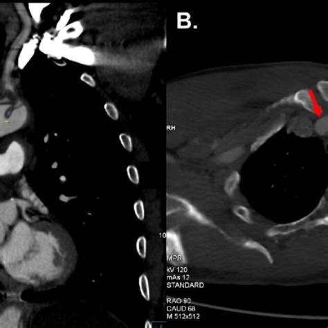Supra Aortic Vessel Dissection Sagittal A And Transverse B Download Scientific Diagram