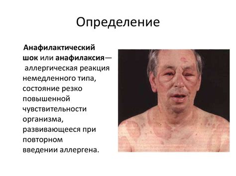Анафилактический шок Неотложная помощь интенсивная терапия презентация онлайн