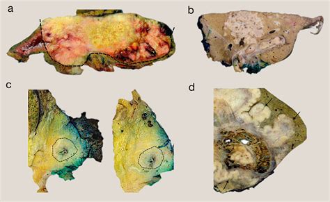 The Morphomolecular Features Of Cholangiocarcinoma In The Personalised Era Diagnostic