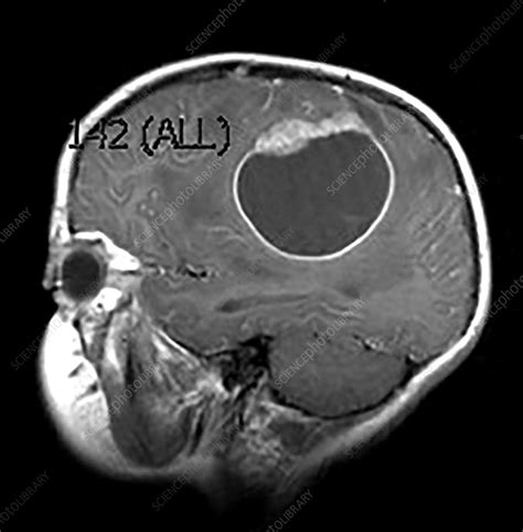 Primitive Neuroectodermal Tumour Pnet Mri Stock Image C043 3159