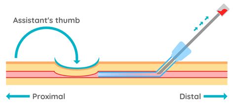 Intravenous Catheter Insertion