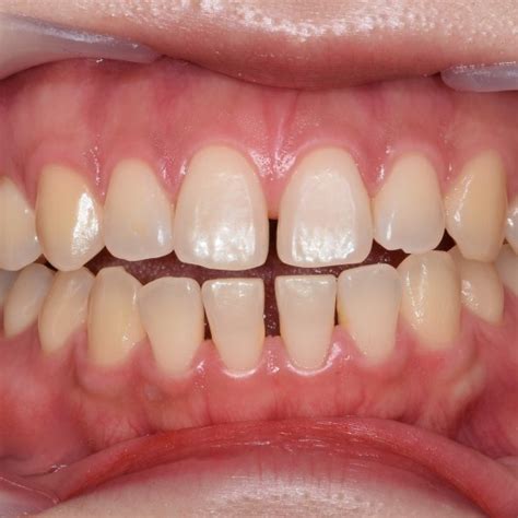 벌어진앞니 레진 수원 우리사랑치과의원