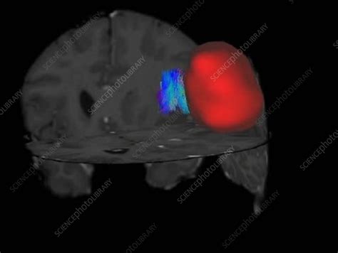 Brain Tumour DTI MRI Scan Stock Video Clip K Science Photo Library