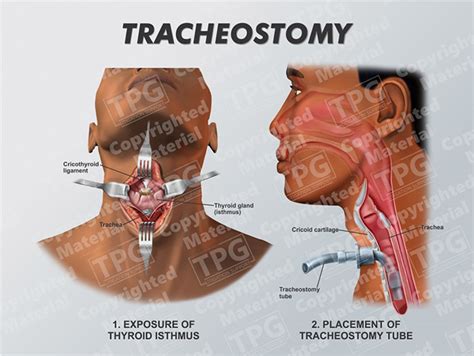 What Is The Reason For Tracheostomy At Alan Johnson Blog