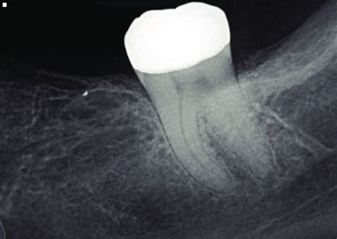 Radiographic Evaluation Of 37 Showing Widening Of Periodontal Ligament