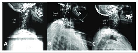 Example Of The Range Of Cervical Sagittal Alignment A Kyphotic Download Scientific Diagram