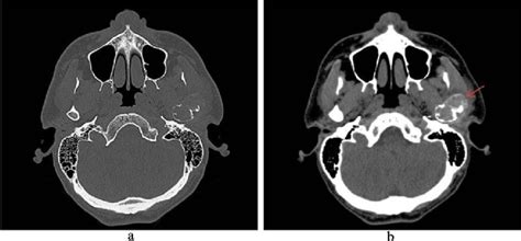 A Bone And B Soft Tissue Algorithm Axial Ct Images Showing An Download Scientific Diagram