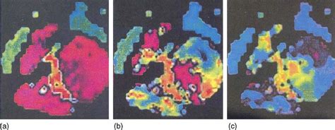 A Sequential Motion Of Endocardium By Radionuclide Ventriculography Download Scientific