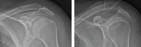 Coracoid Acromion Fractures
