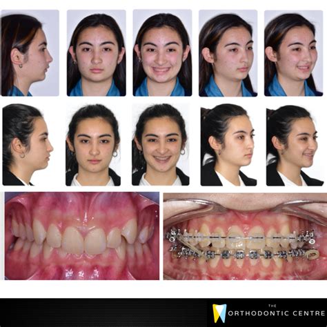 Jaw Problems The Orthodontic Centre