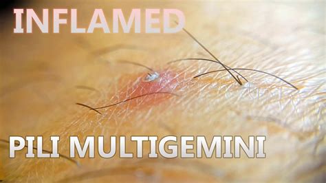 Hair Follicle When Pulled Out At Linda Gary Blog