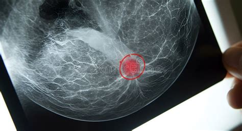 Mammogram Analysis Detecting Breast Cancer Through Radiological