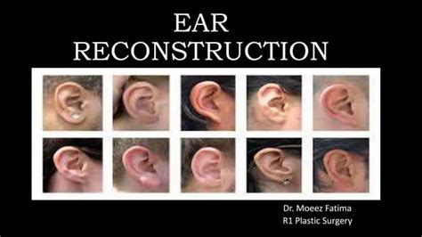 Auricular Reconstruction Pptx