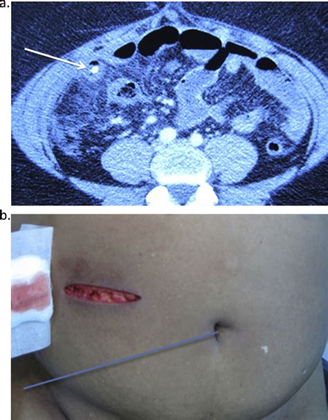 A Axial Ct Scan With Iv Contrast Showing An Appendicolith Straight Download Scientific