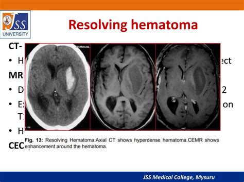 Ring Enhancing Lesions¹111222222222111112 Ppt