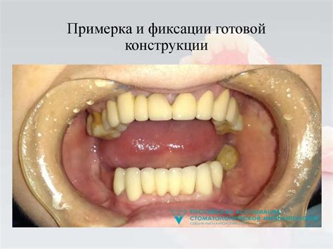Функциональное состояние зубочелюстной системы при частичном отсутствии зубов Выбор конструкции