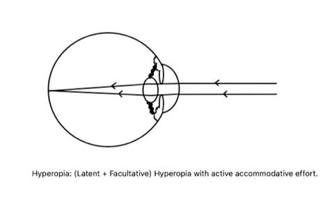 [figure Hyperopia Latent Facultative Hyperopia With Accommodation ] Statpearls Ncbi
