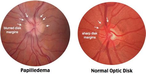 Papilledema Vs Normal