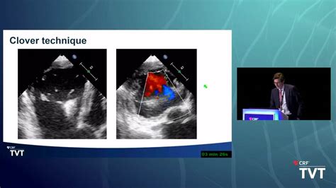 T Teer Device Strategies Multiple Leaflets