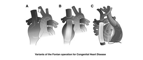 Atrial Flutter Ablation One Heart Cardiology