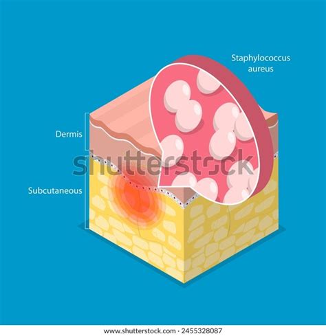 3d Isometric Flat Vector Illustration Cellulitis Stock Vector Royalty