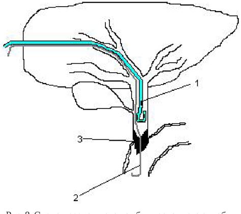 Figure 1 From Prevention Of Purulent Cholangitis After Percutaneous