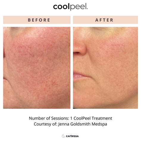 Coolpeel™ Treatment Before And After Gallery