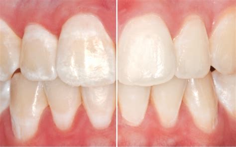 Icon Infiltration Before And After