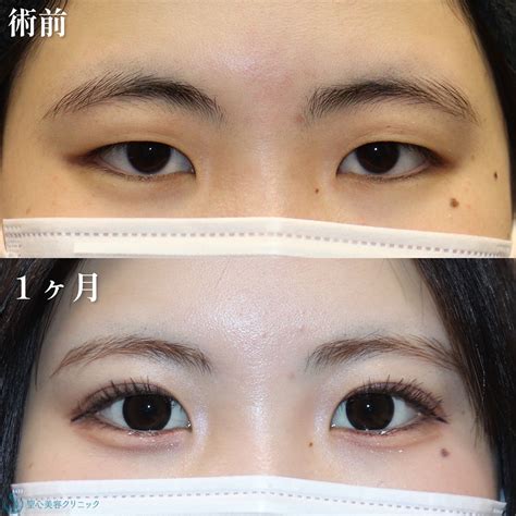 【20代女性・埋没法で目を大きく華やかに】二重術（埋没法）：マイクロメソッド α（1ヶ月後） 症例写真 美容整形、美容外科なら聖心美容