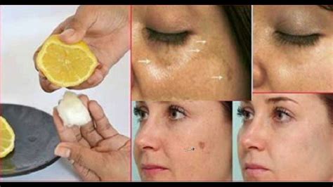 How To Remove Dark Spots On Your Skin At John Tabarez Blog