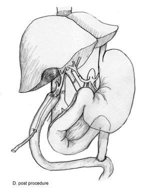 Choledochojejunostomy Technique Creation Of Biliary Jejunal Anastomosis Complications