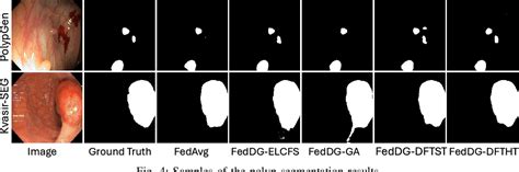 Frequency Based Federated Domain Generalization For Polyp Segmentation