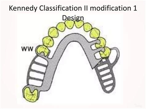 Removable Partial Denture Kennedy Classification At Anna Waldron Blog