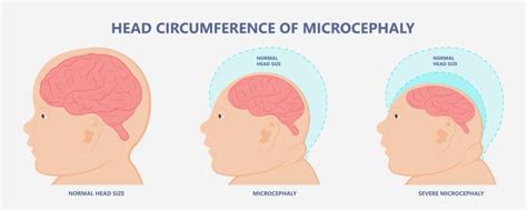 Macrocephaly Ultrasound