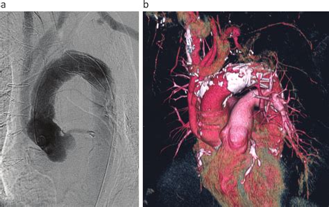 A B Postoperative Thoracic Dsa Angiography A And Download Scientific Diagram