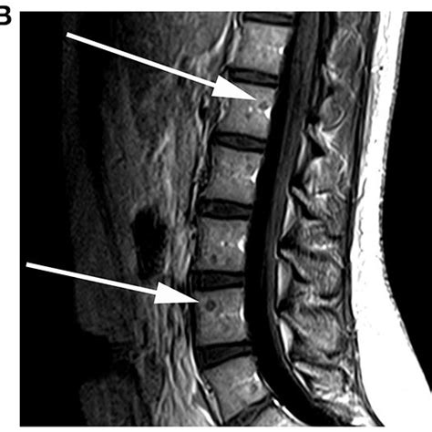 A 17 Year Old Female With H3f3a G34r Mutated Infiltrative Glioma An