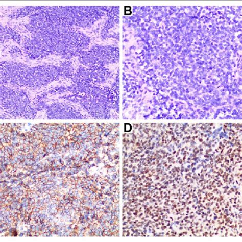 The Pathological Results Of Extraosseous Ewing Sarcoma Of Cervical Download Scientific Diagram