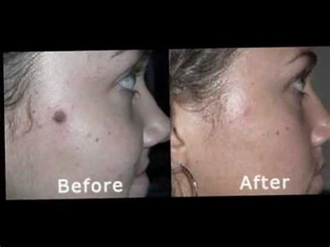 Wart Removal Treatment Before And After Pictures No Surgery Youtube