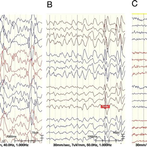 Brain Magnetic Resonance Imaging Of Bilateral Frontoparietal Download Scientific Diagram